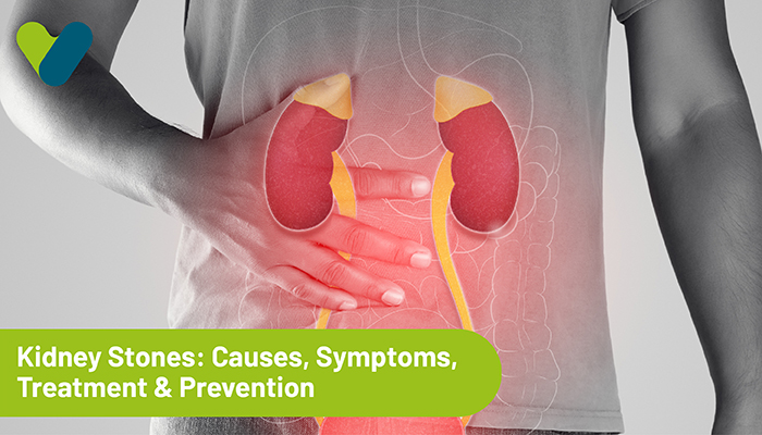 Kidney Stones: Comprehensive Guide To Kidney Stones, Its Symptoms ...